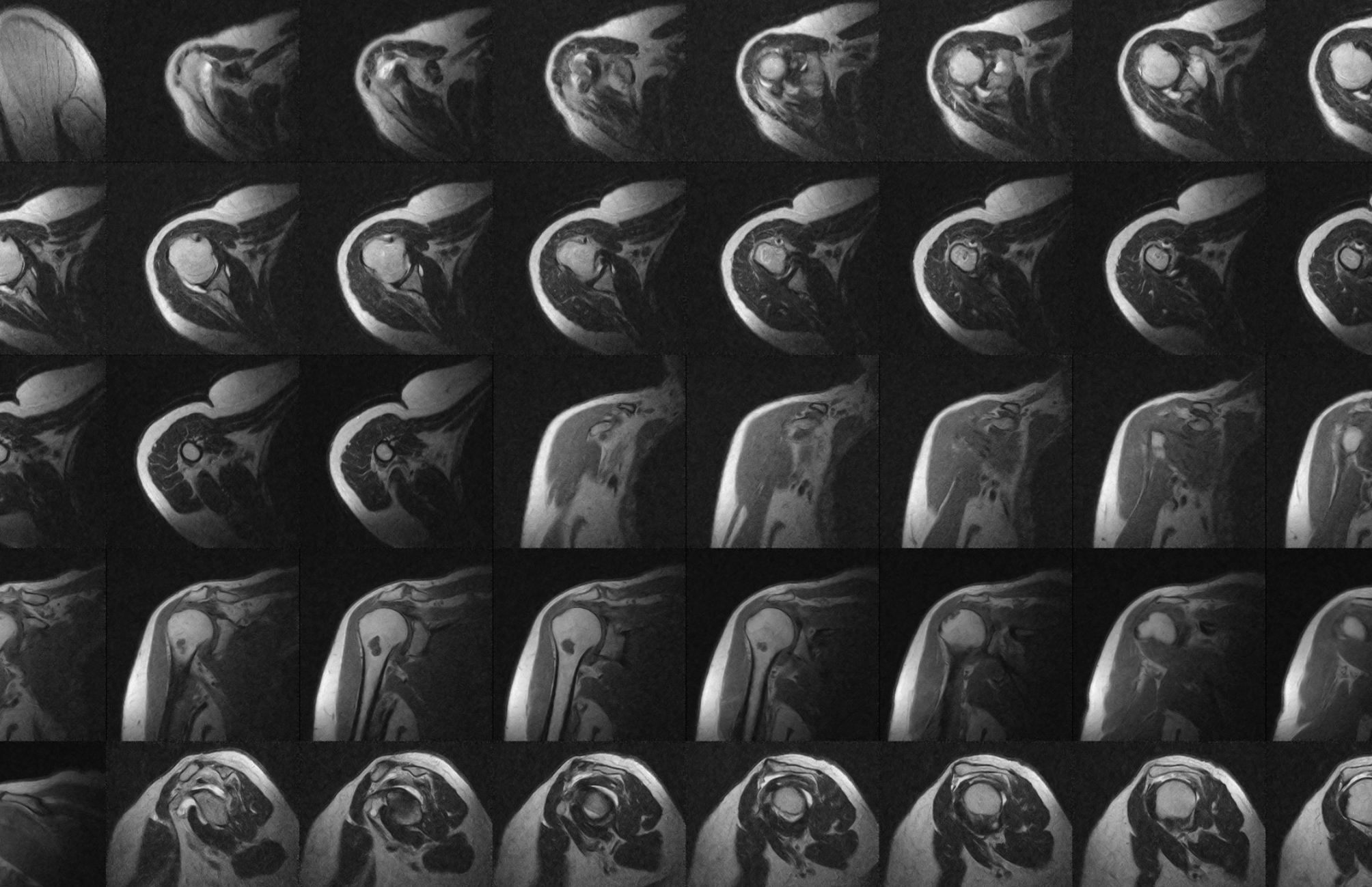 Sottospinato: Anatomia, Funzione e Trattamento delle Lesioni